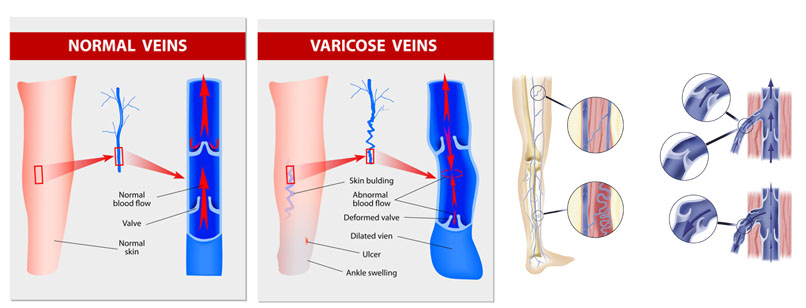 Tretman vena – Poliklinika Arbor Vitae Dr. Sarić